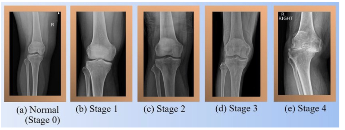 Knee Osteoarthritis - Hawker Place Physiotherapy and Pilates